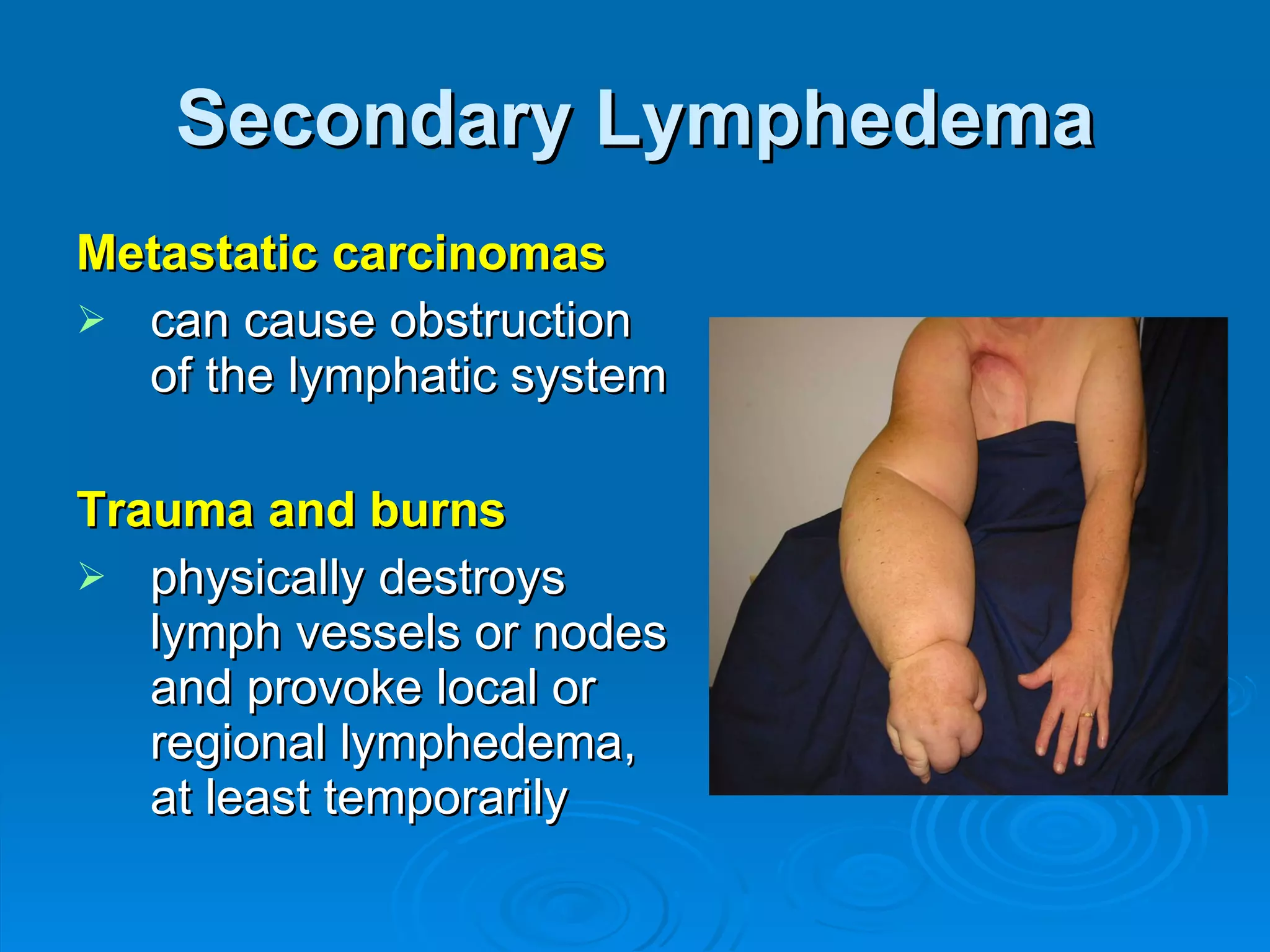 Lymphedema an overview | PPT