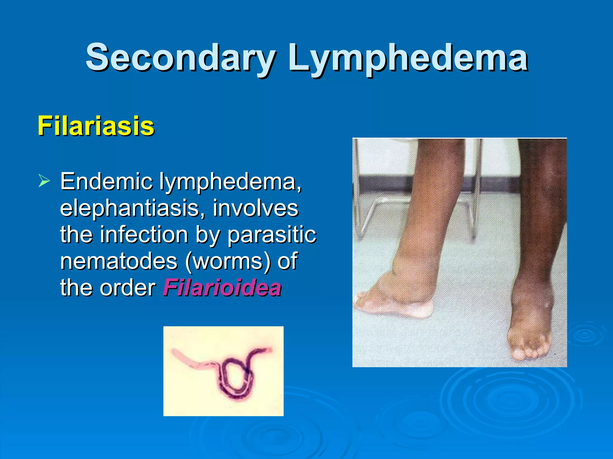 Lymphedema an overview | PPT
