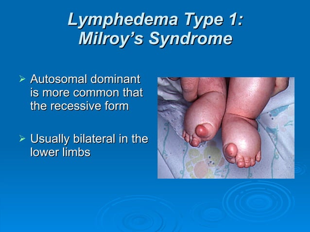 Lymphedema an overview
