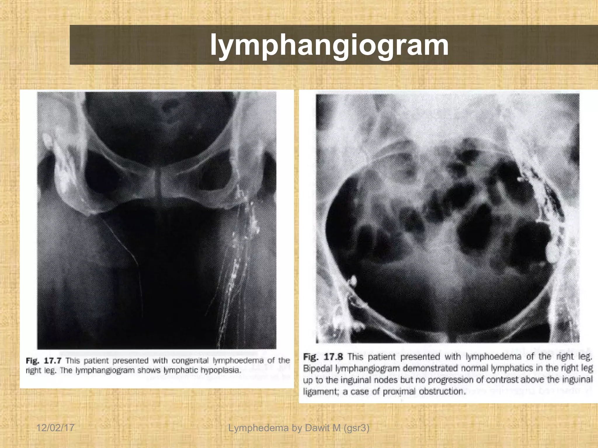 Lymphedema by Dr.dawit surgical resident@ Jimma university | PPT