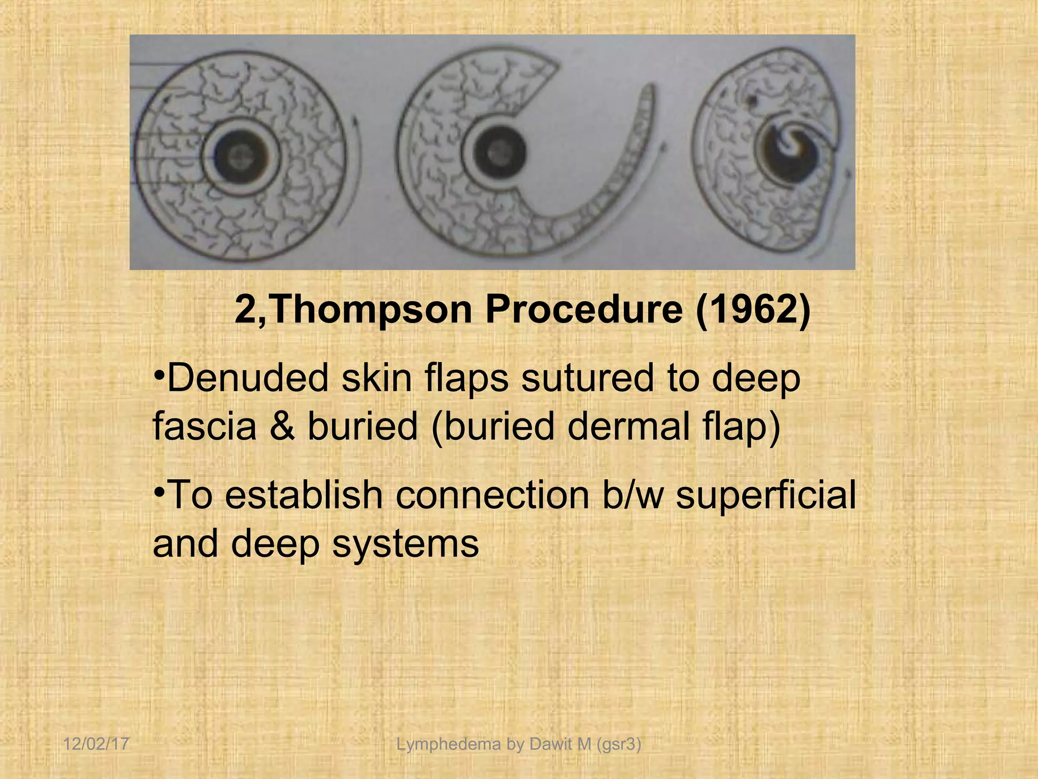 Lymphedema by Dr.dawit surgical resident@ Jimma university | PPT