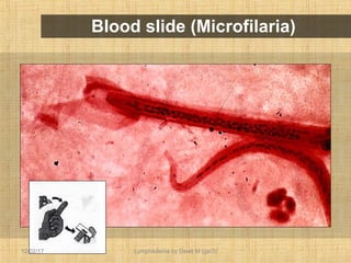 Lymphedema by Dr.dawit surgical resident@ Jimma university | PPT