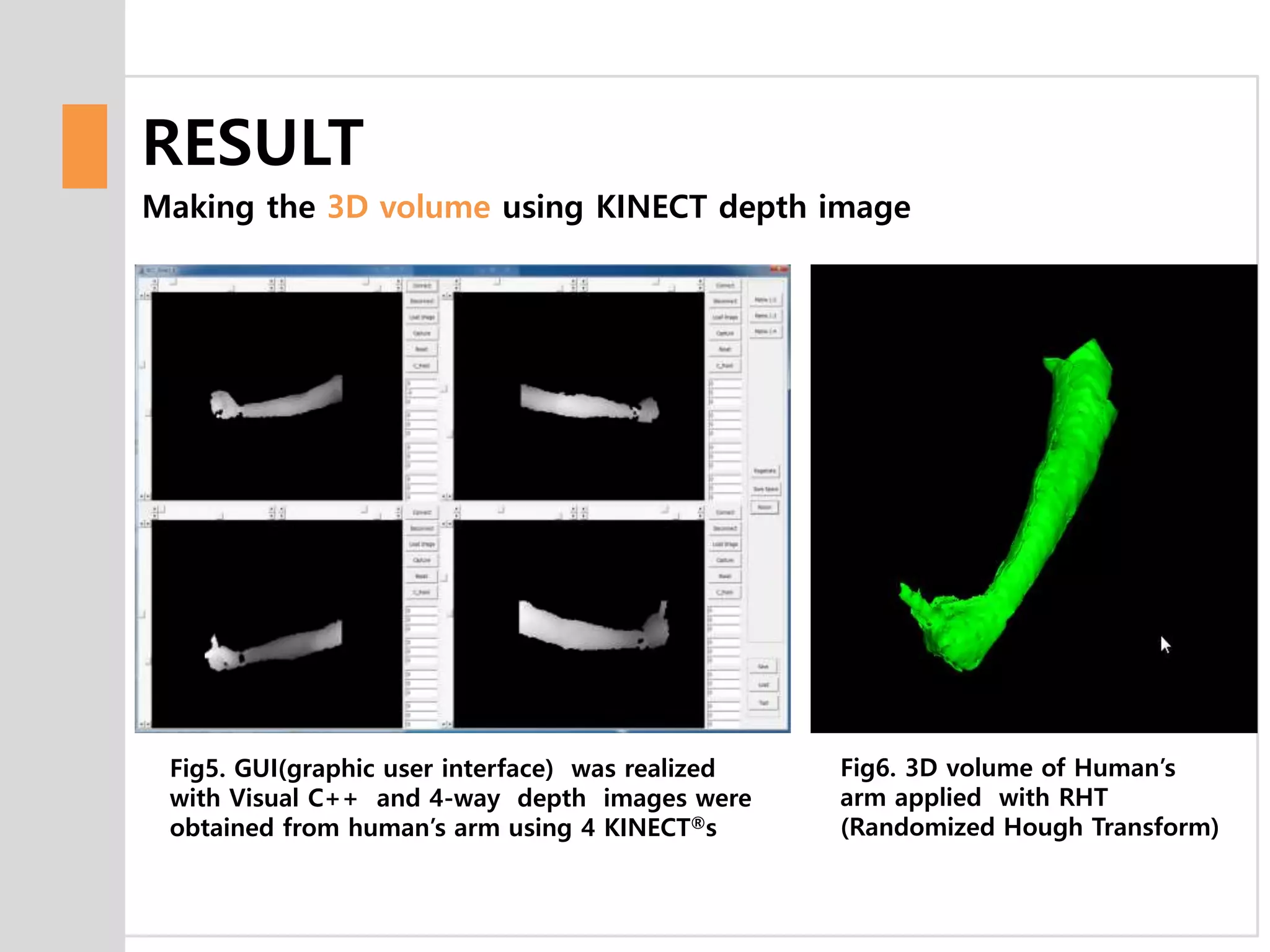 Lymphedema measurement using kinect volume reconstruction | PPTX | 3-D Graphics | Computer ...