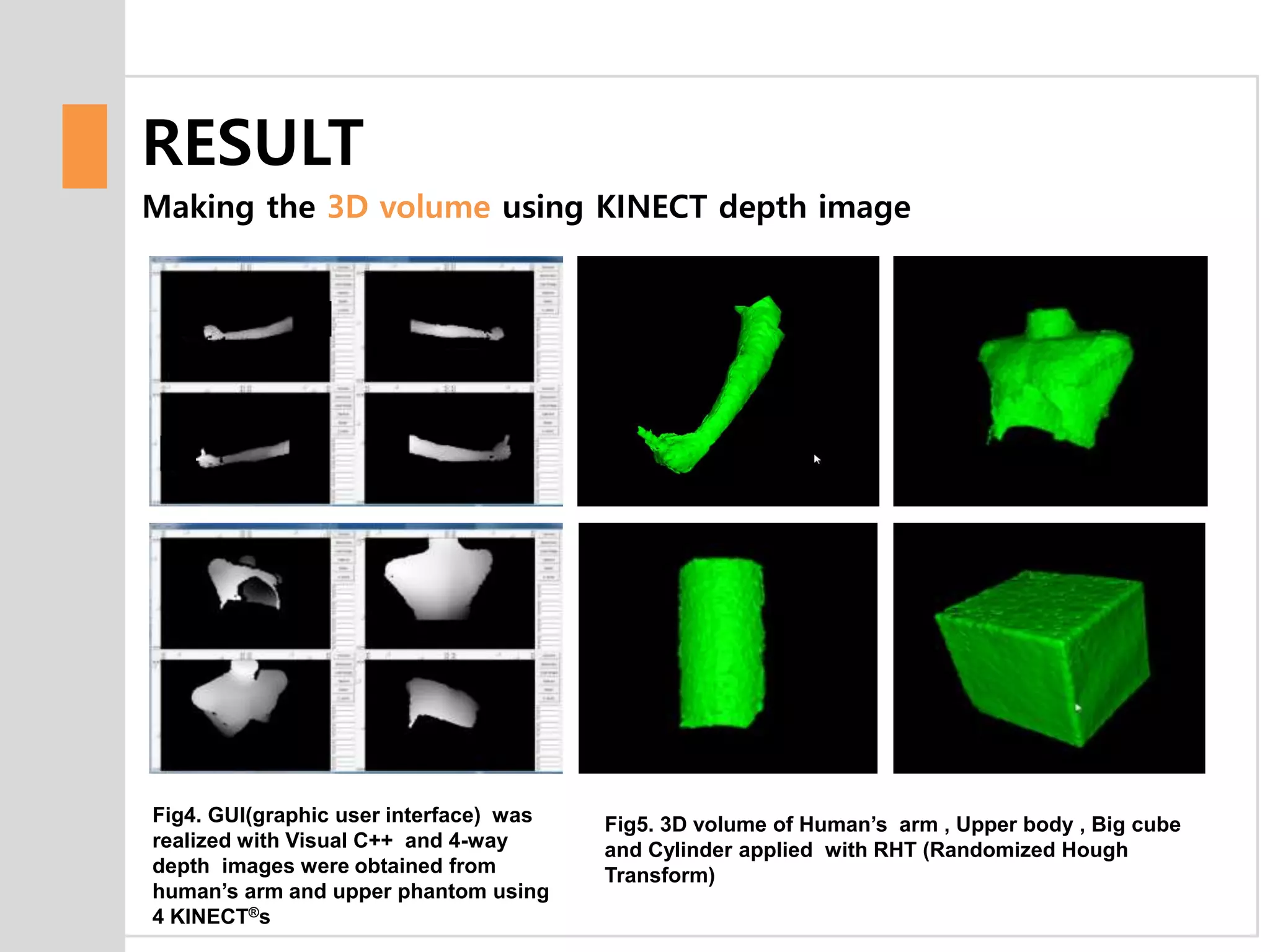 Lymphedema measurement using kinect volume reconstruction | PPTX | 3-D Graphics | Computer ...