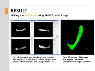 Lymphedema measurement using kinect volume reconstruction | PPTX | 3-D Graphics | Computer ...