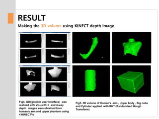 Lymphedema measurement using kinect volume reconstruction | PPTX | 3-D Graphics | Computer ...