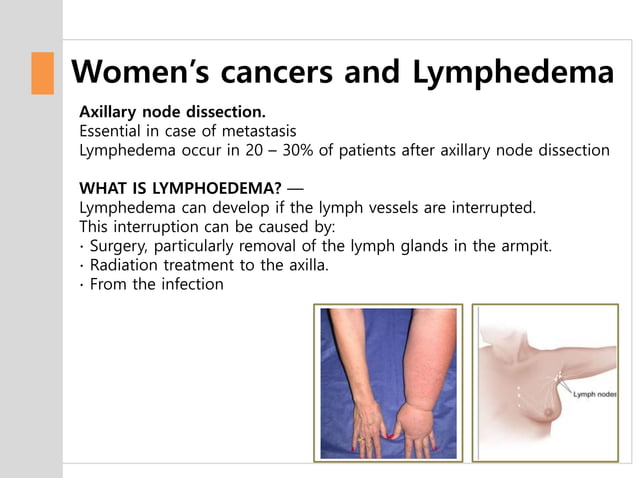 Lymphedema Measurement Using Kinect Volume Reconstruction Pptx 3 D Graphics Computer