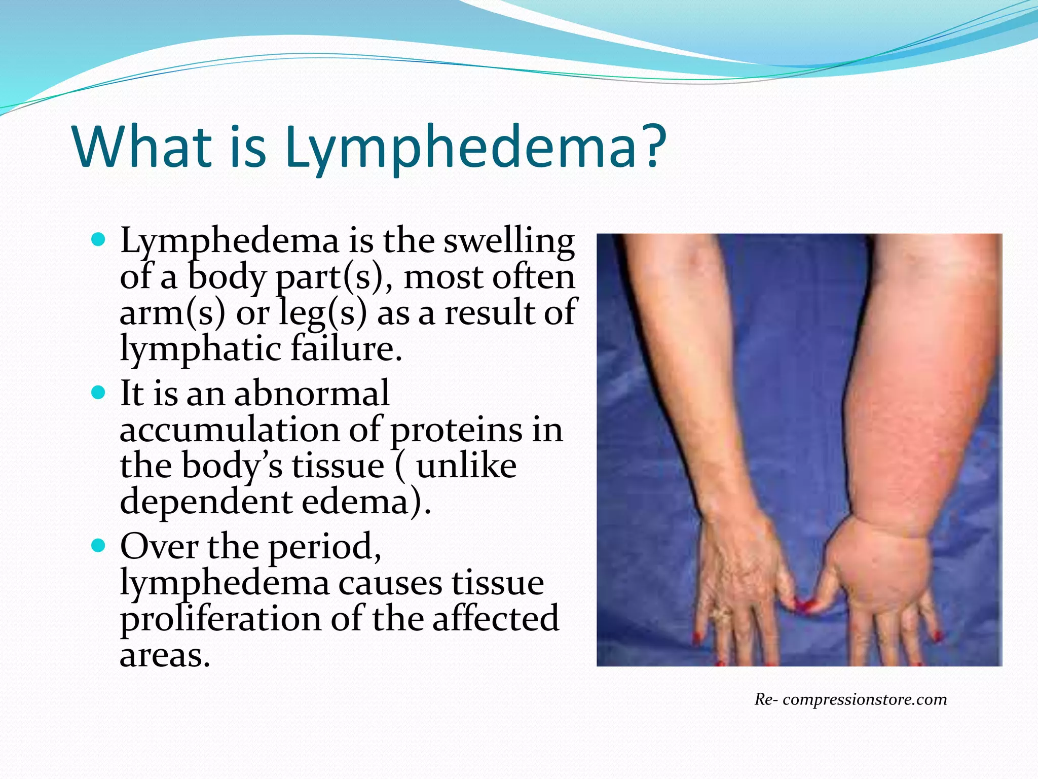A preview of lymphedema treatment and management | PPTX