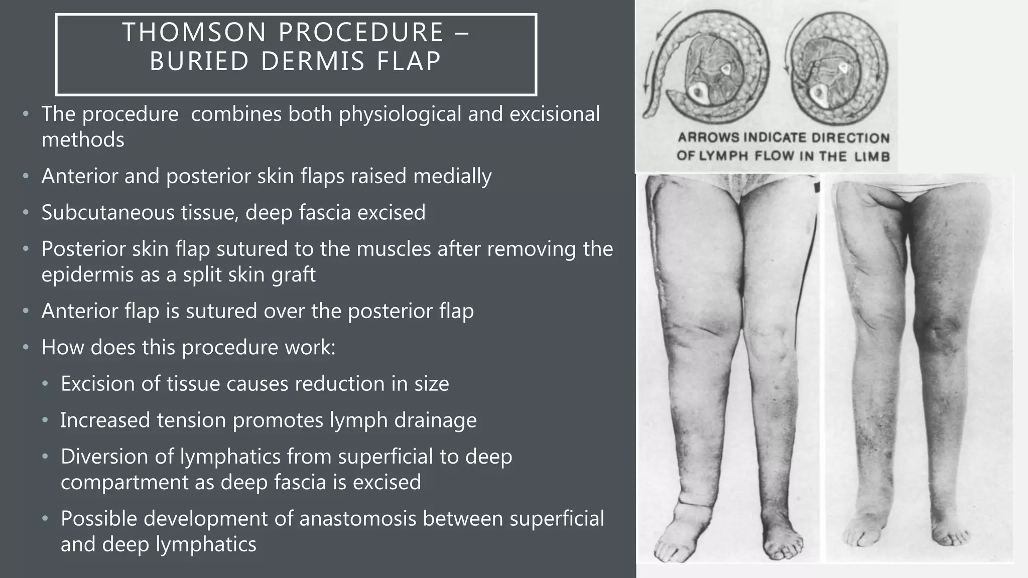 Lymphedema | PPTX