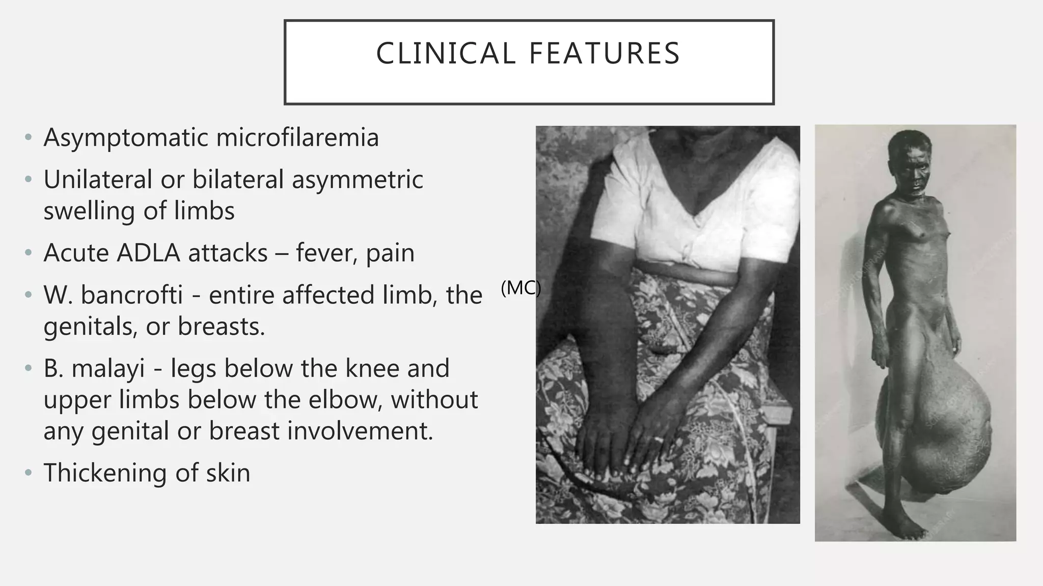Lymphedema | PPTX | Surgery | Medical Health