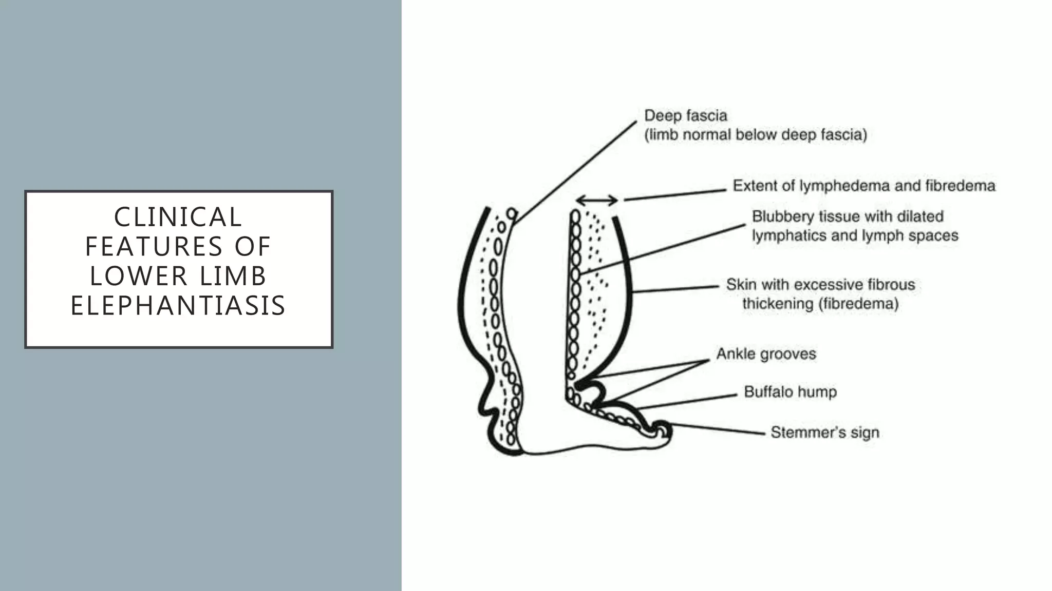 Lymphedema | PPTX