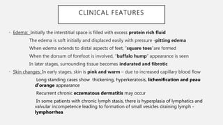 Lymphedema | PPTX