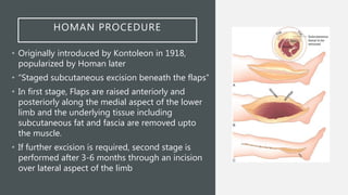 Lymphedema | PPTX