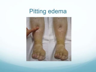 Lymphedemasharepoint2 | PPT