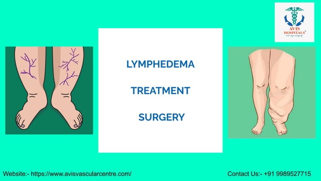 LYMPHEDEMA TREATMENT SURGERY.pdf