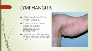 Lymph mh | PPTX