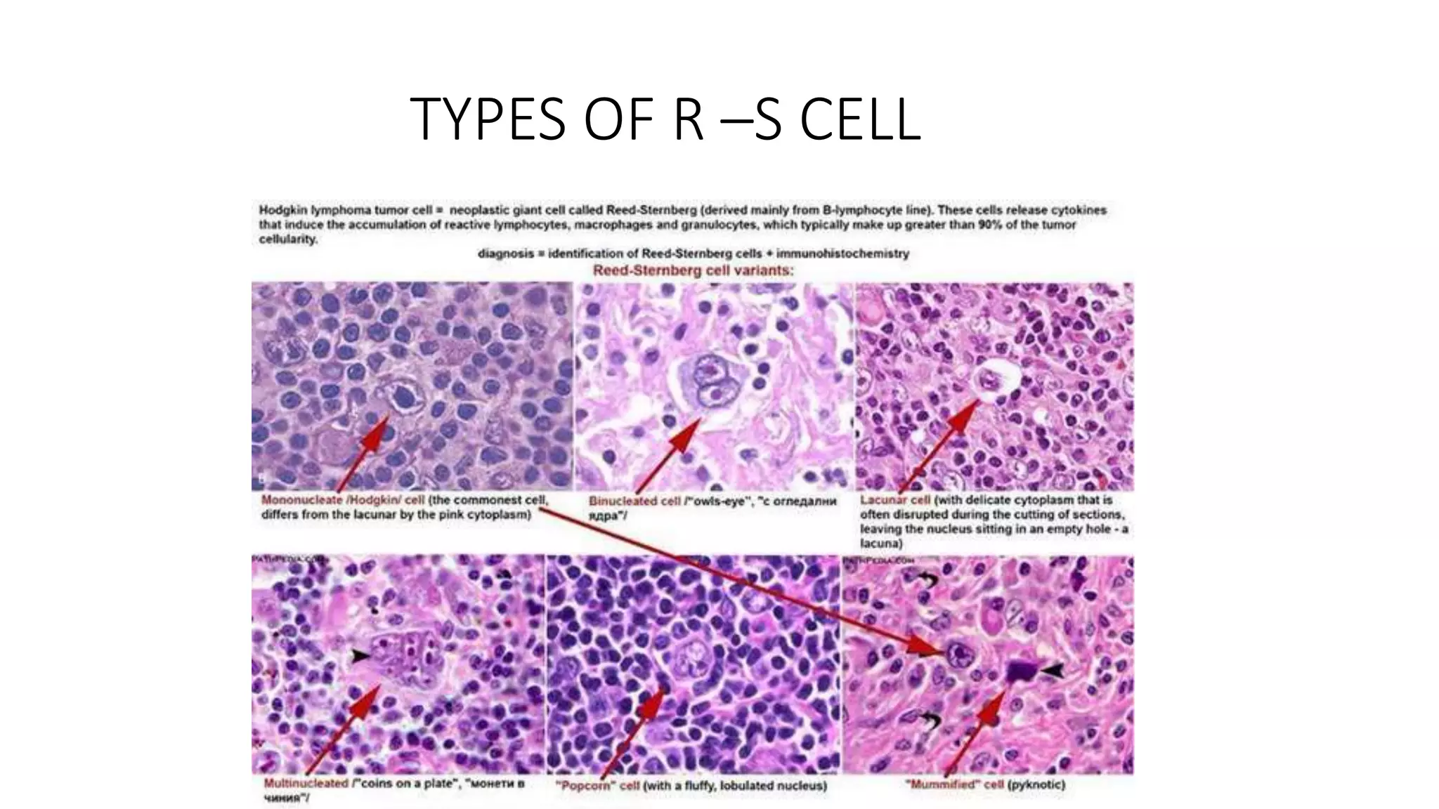 approach to lymph node cytology part 2 | PPTX