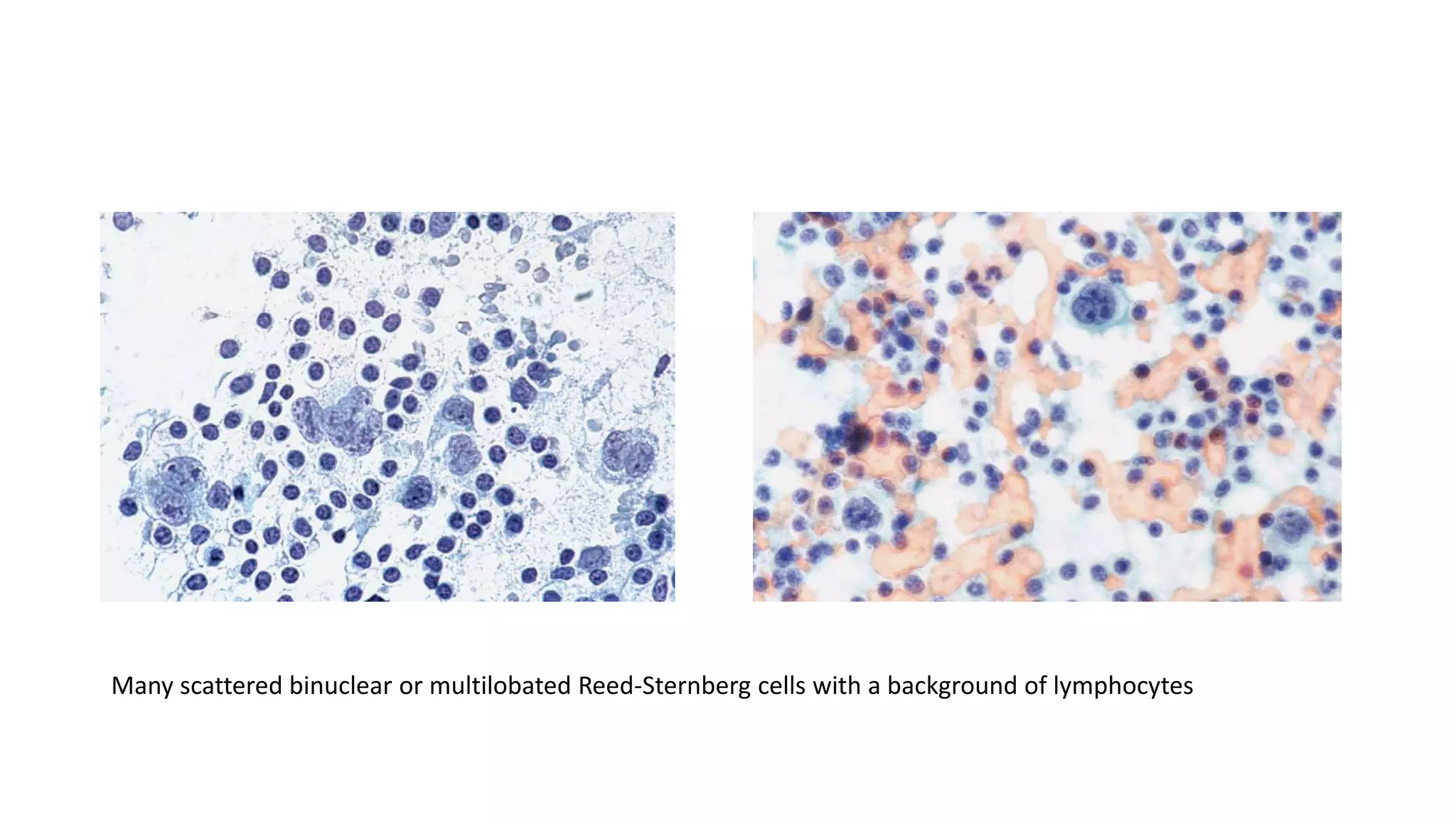 approach to lymph node cytology part 2 | PPTX