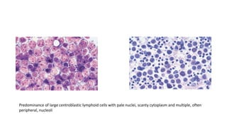 approach to lymph node cytology part 2 | PPTX