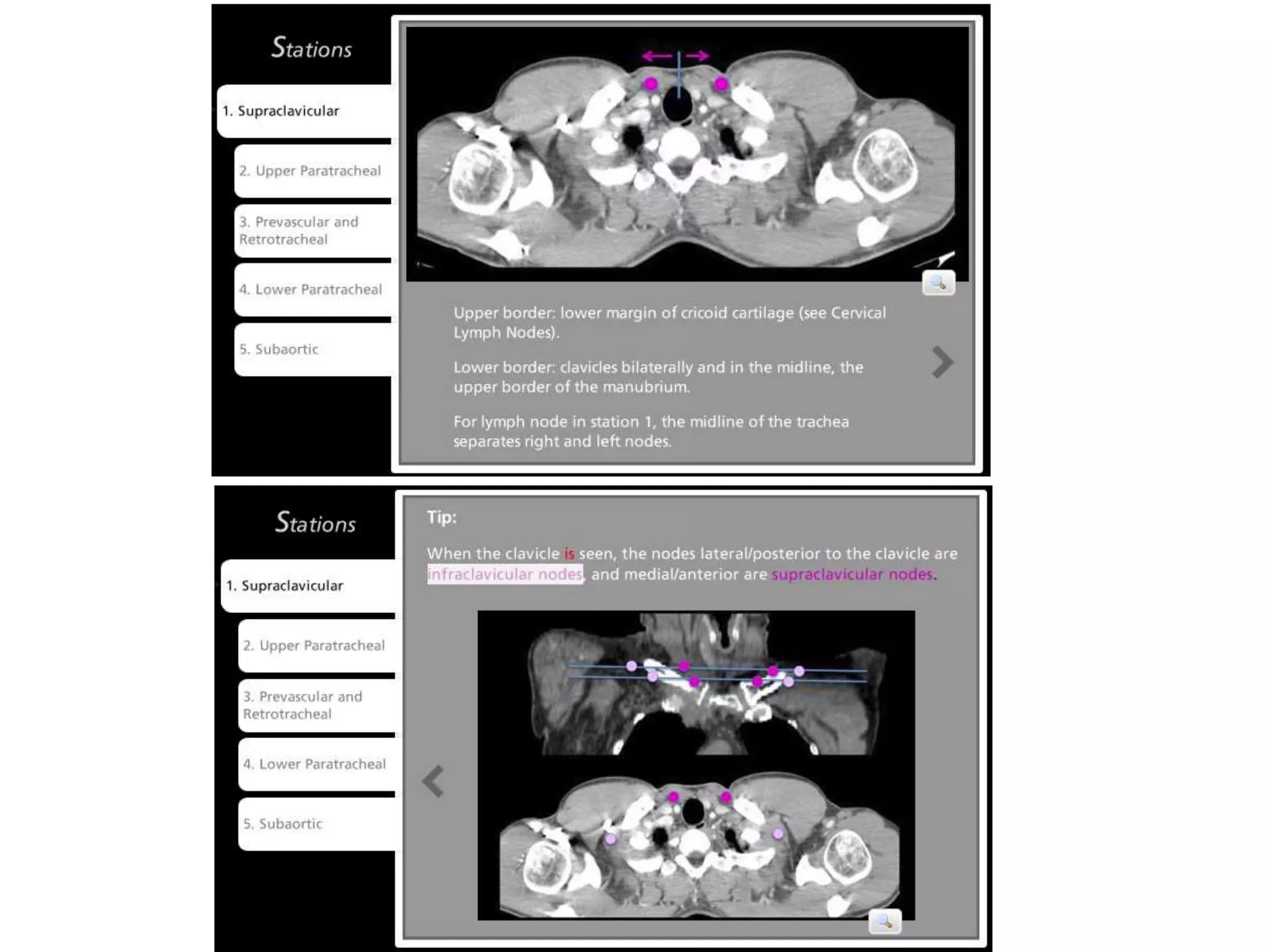 Lymph node anatomy for pet ct | PPT