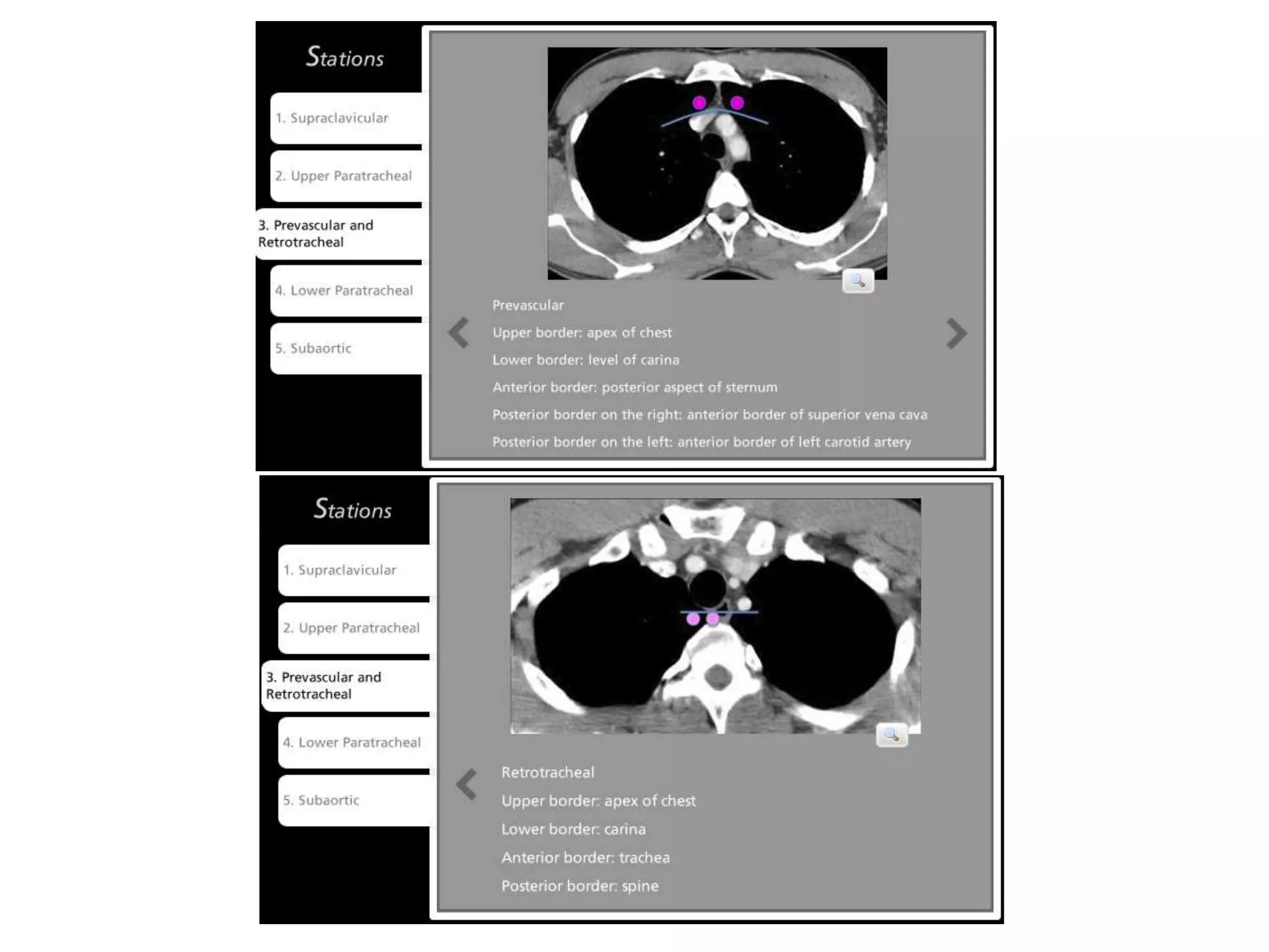 Lymph node anatomy for pet ct | PPT