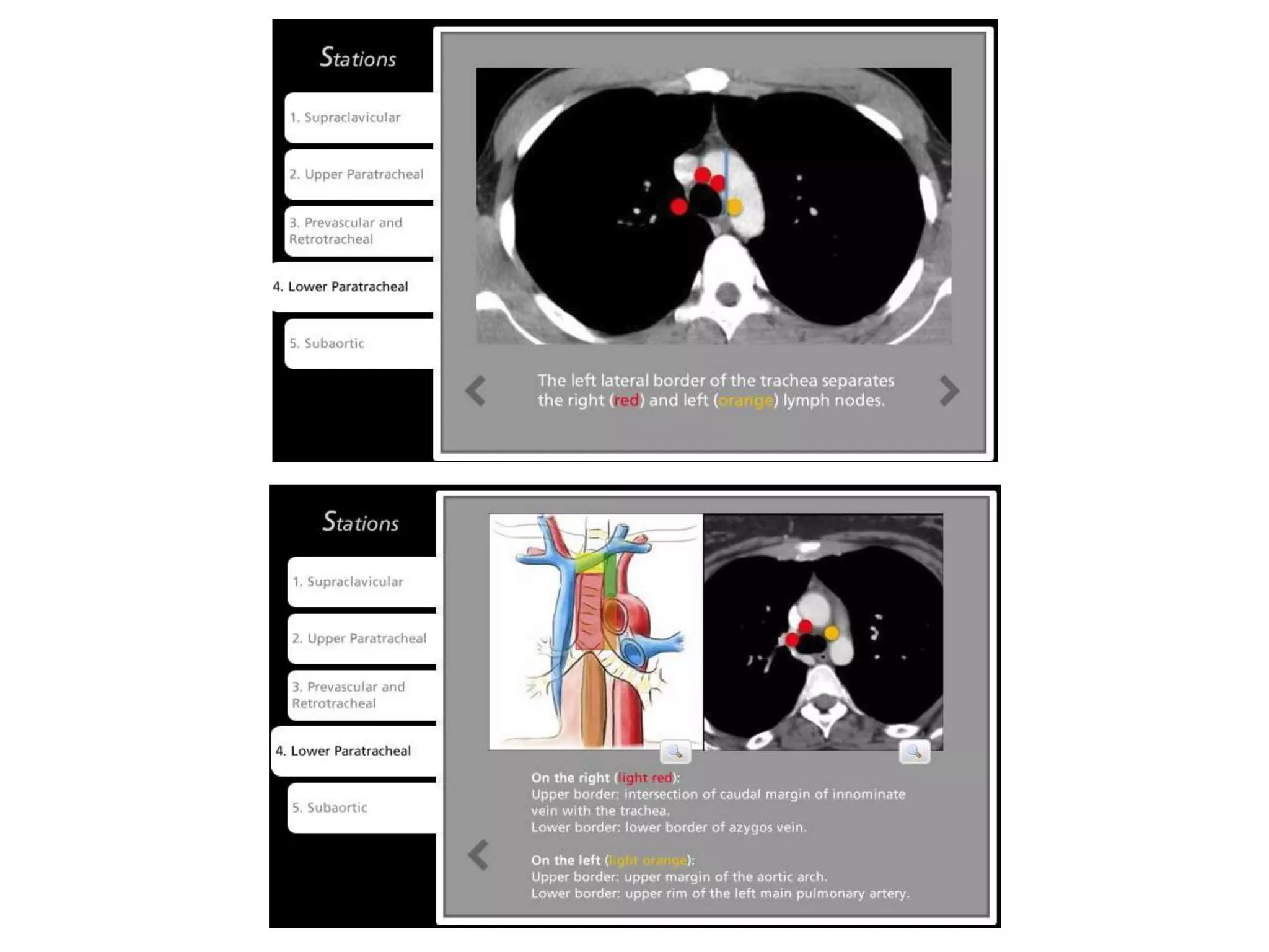 Lymph node anatomy for pet ct | PPT