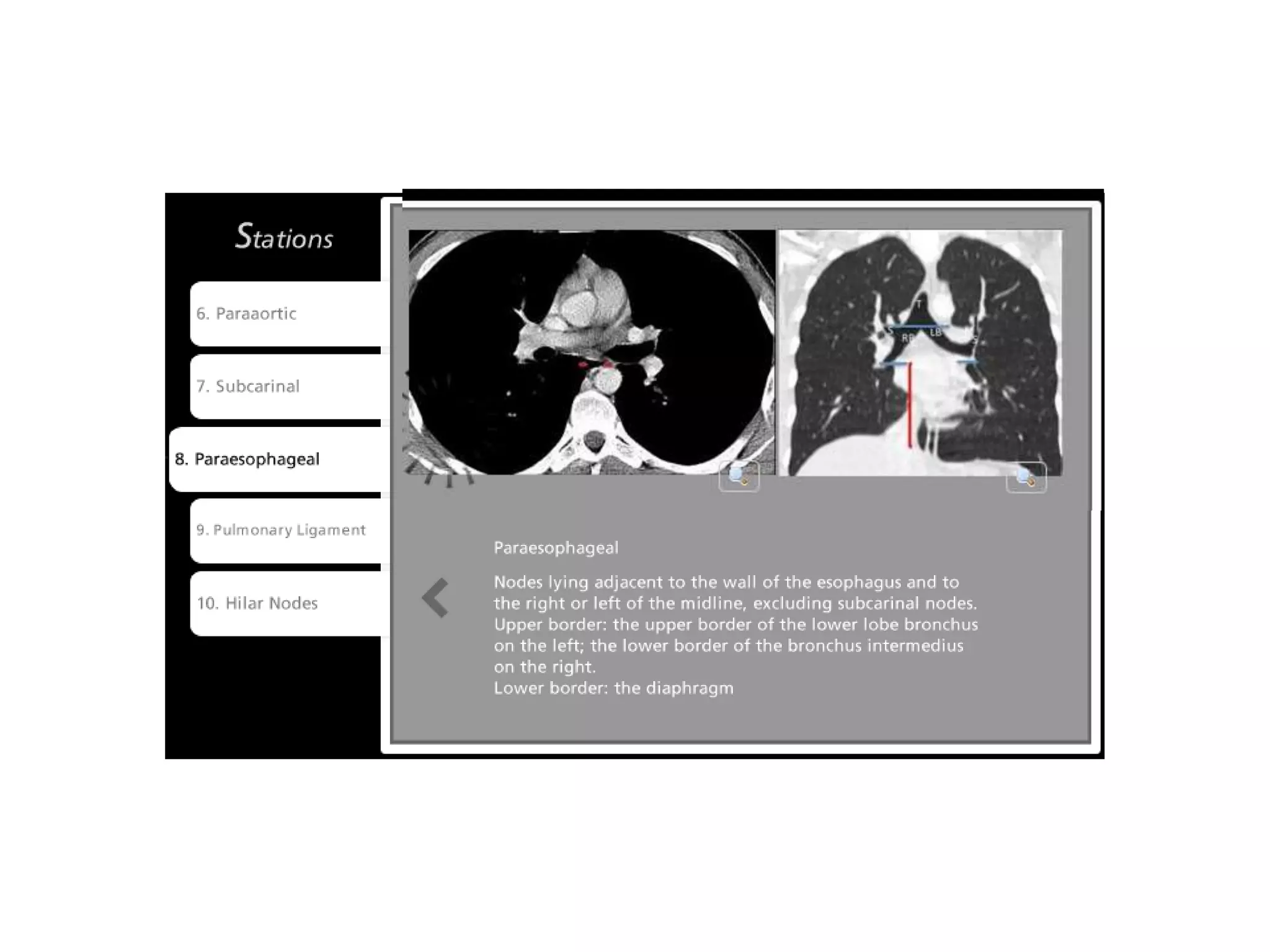 Lymph node anatomy for pet ct | PPT