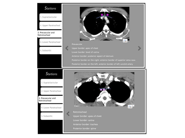 Lymph node anatomy for pet ct | PPT