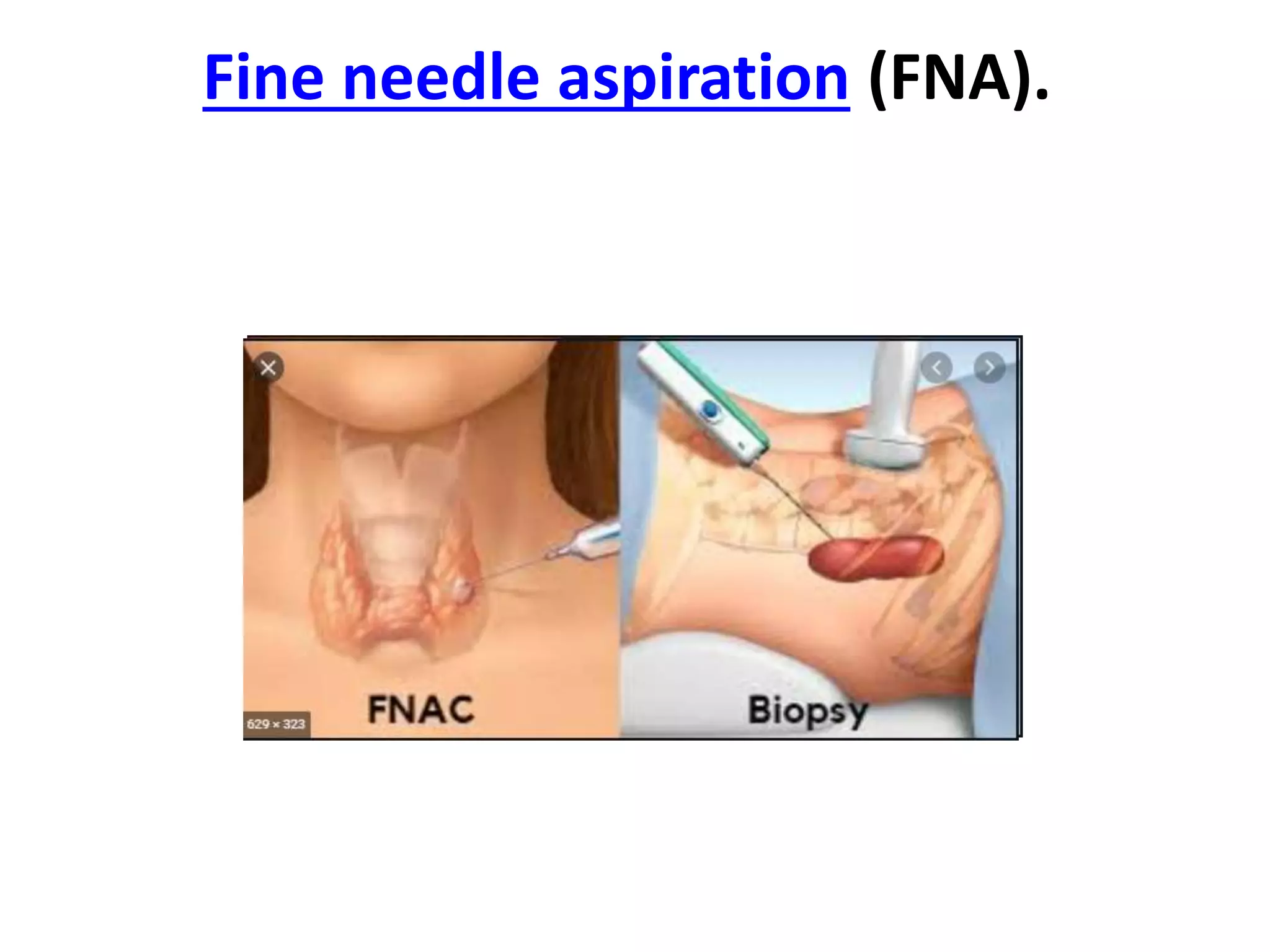 Lymph node biopsy | PPTX