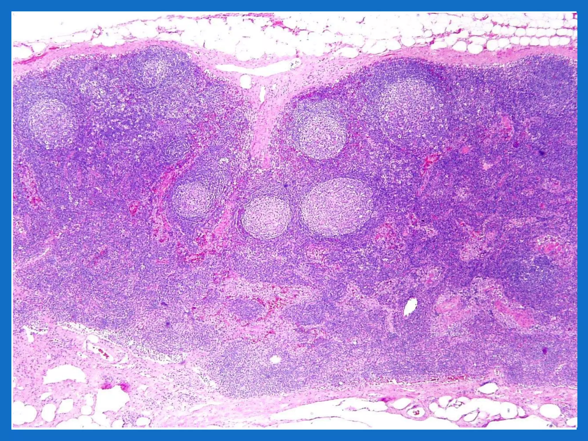 Histology and pathology of lymph nodes | PPTX