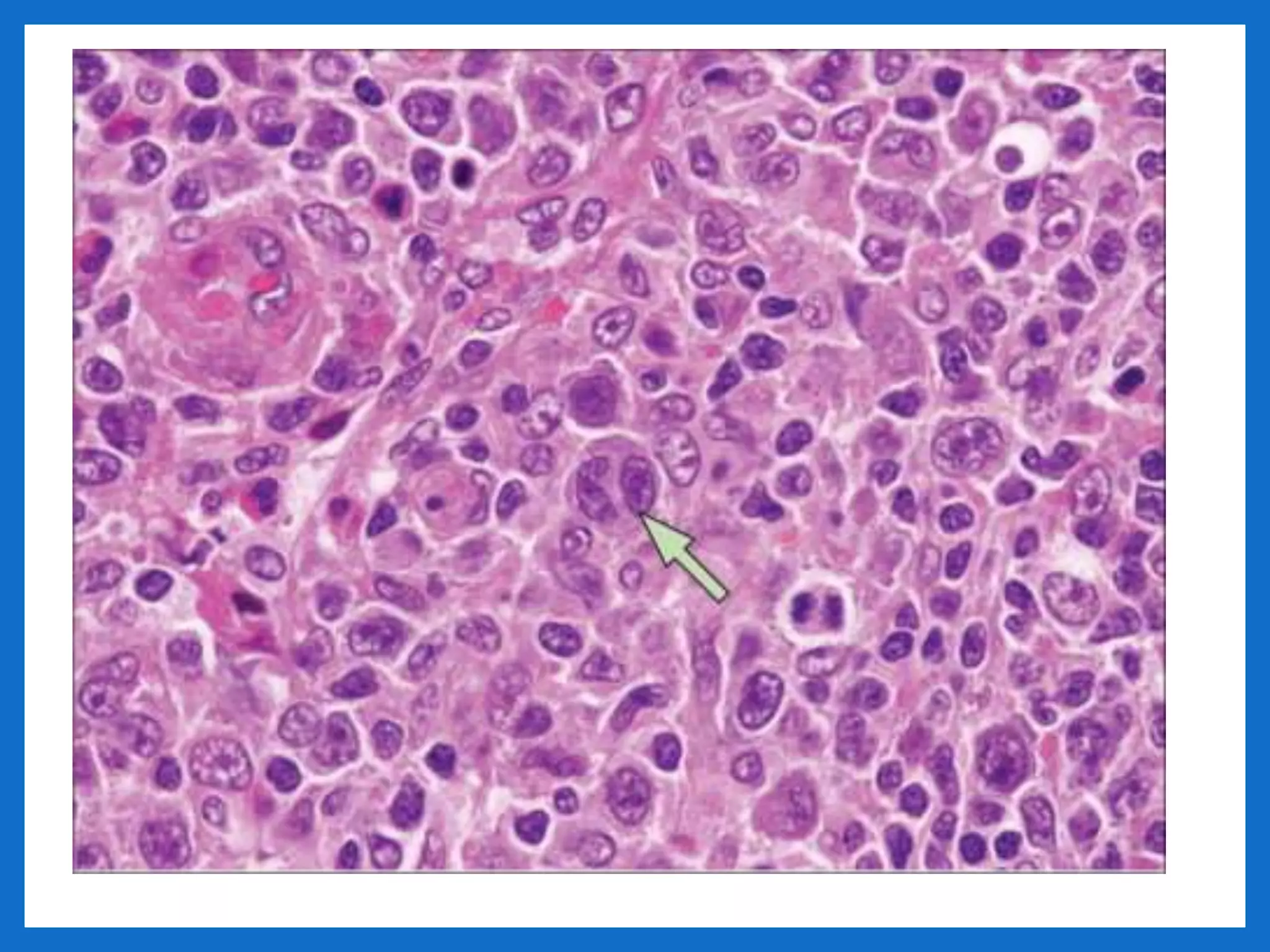 Histology and pathology of lymph nodes | PPTX