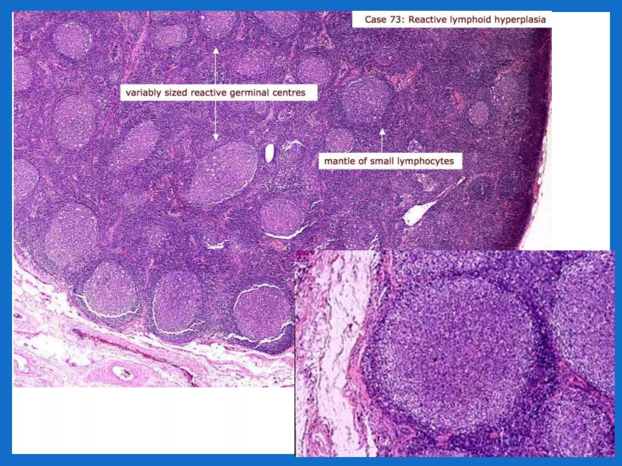 Histology and pathology of lymph nodes | PPTX