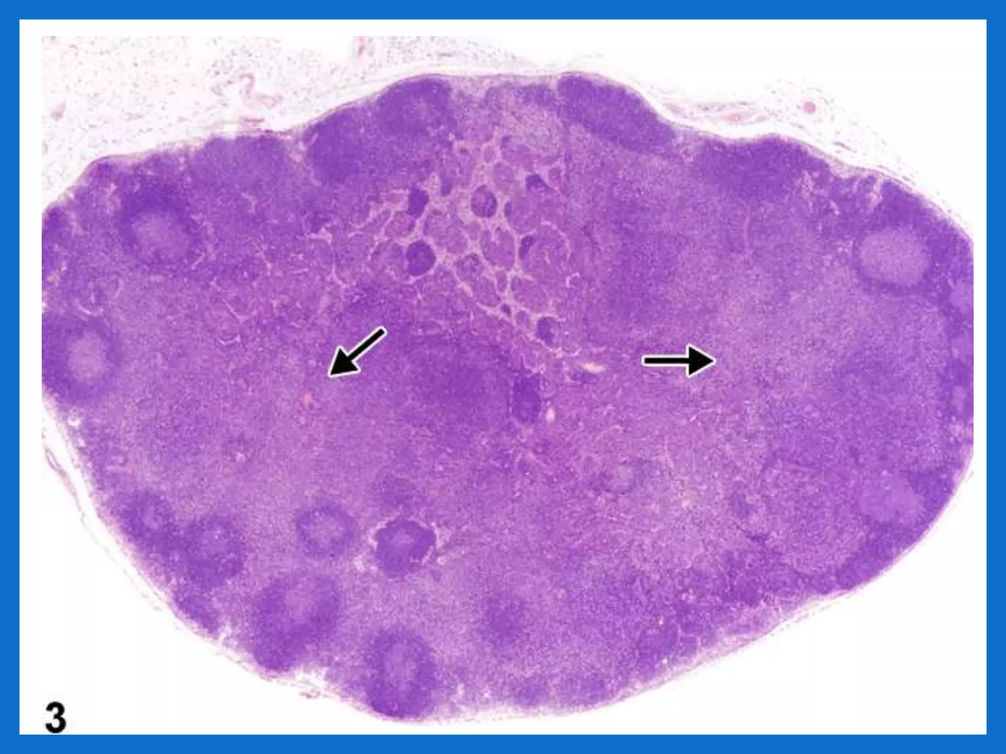 Histology and pathology of lymph nodes | PPTX