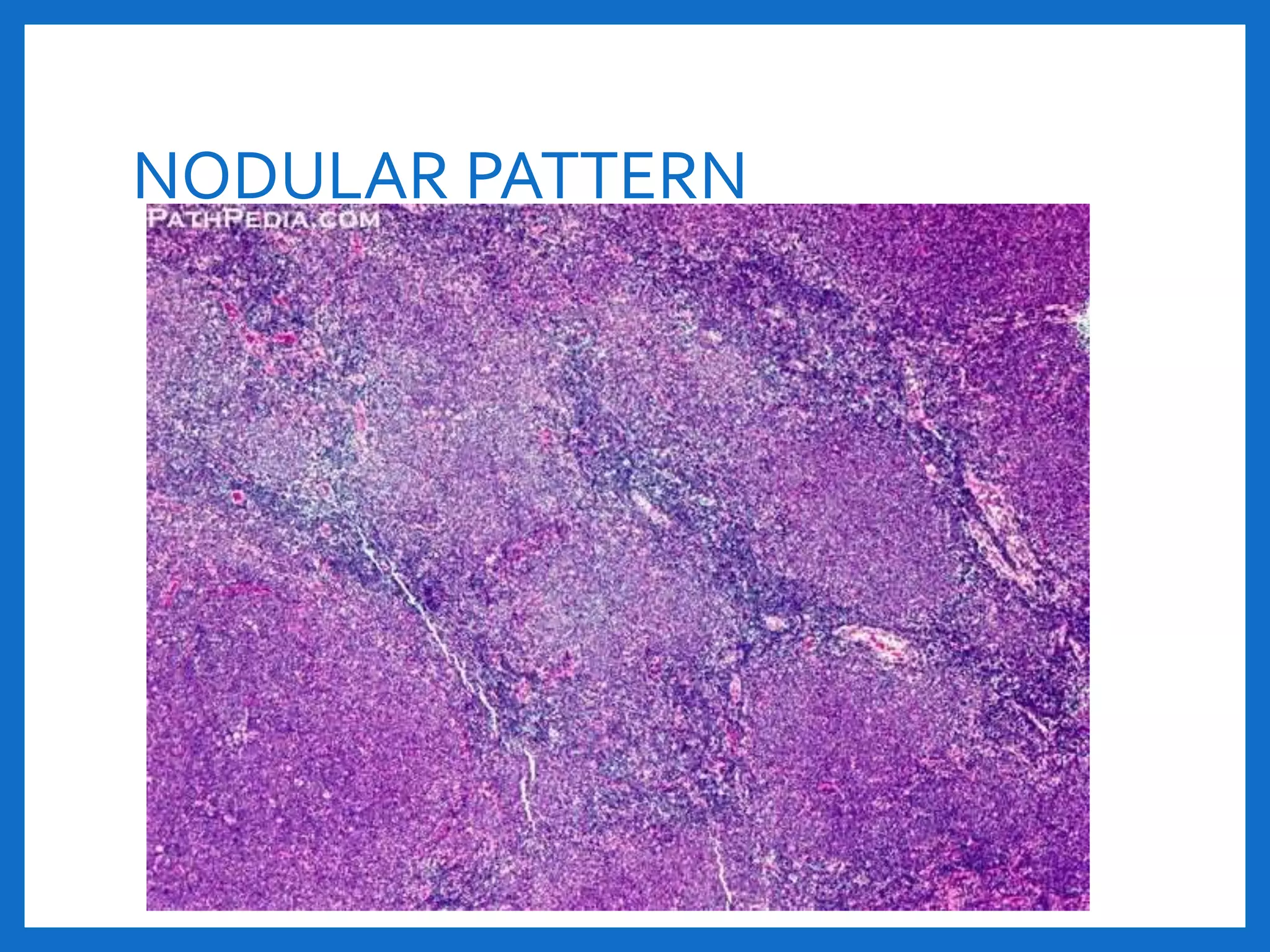 Histology and pathology of lymph nodes | PPTX