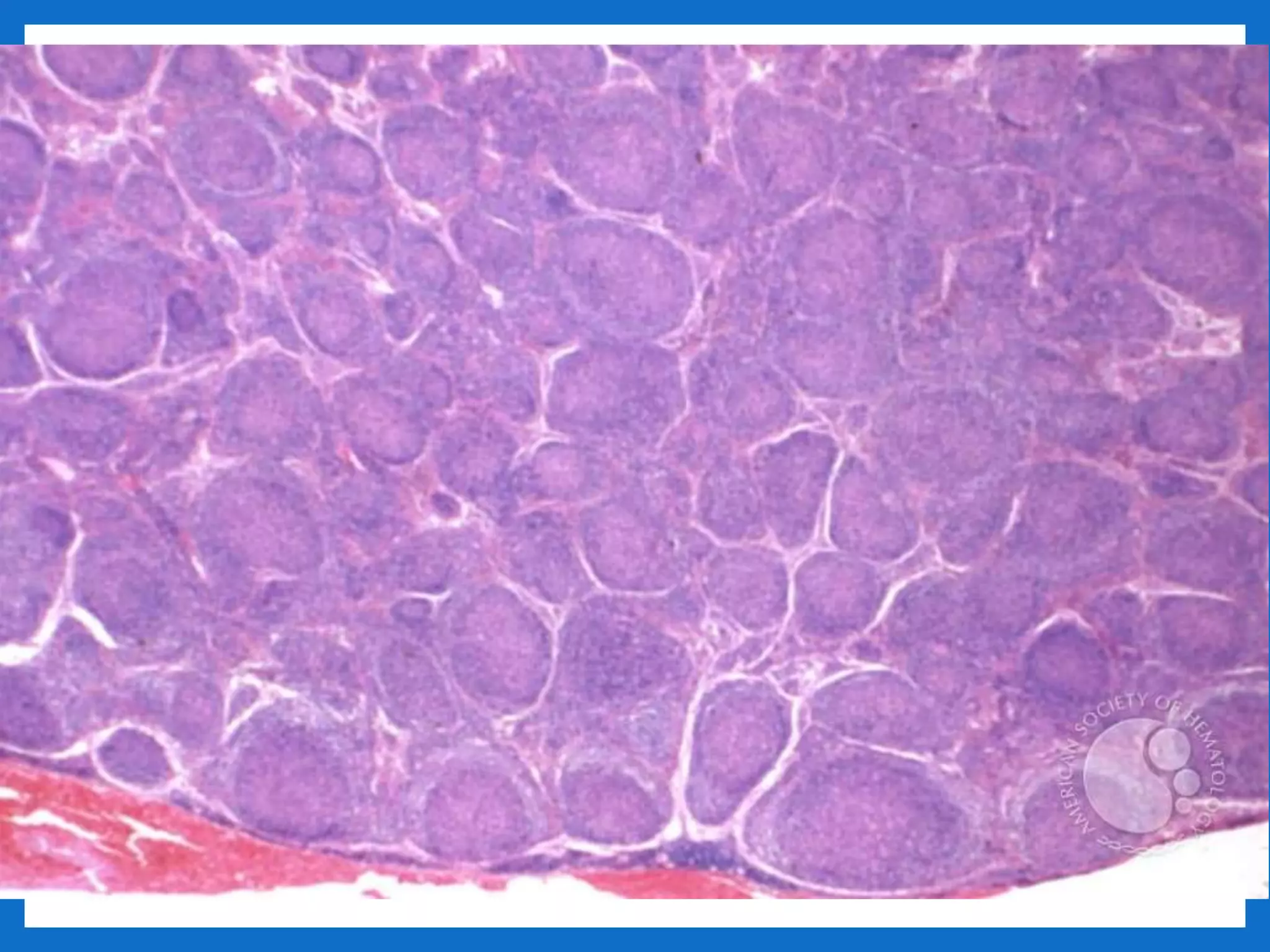 Histology and pathology of lymph nodes | PPTX