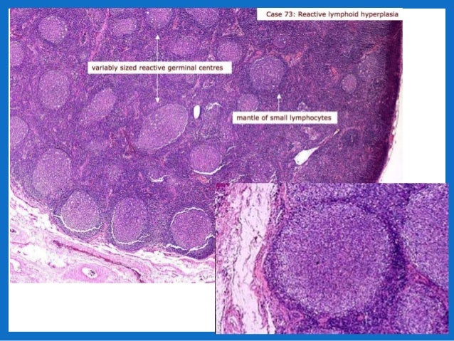 Histology and pathology of lymph nodes