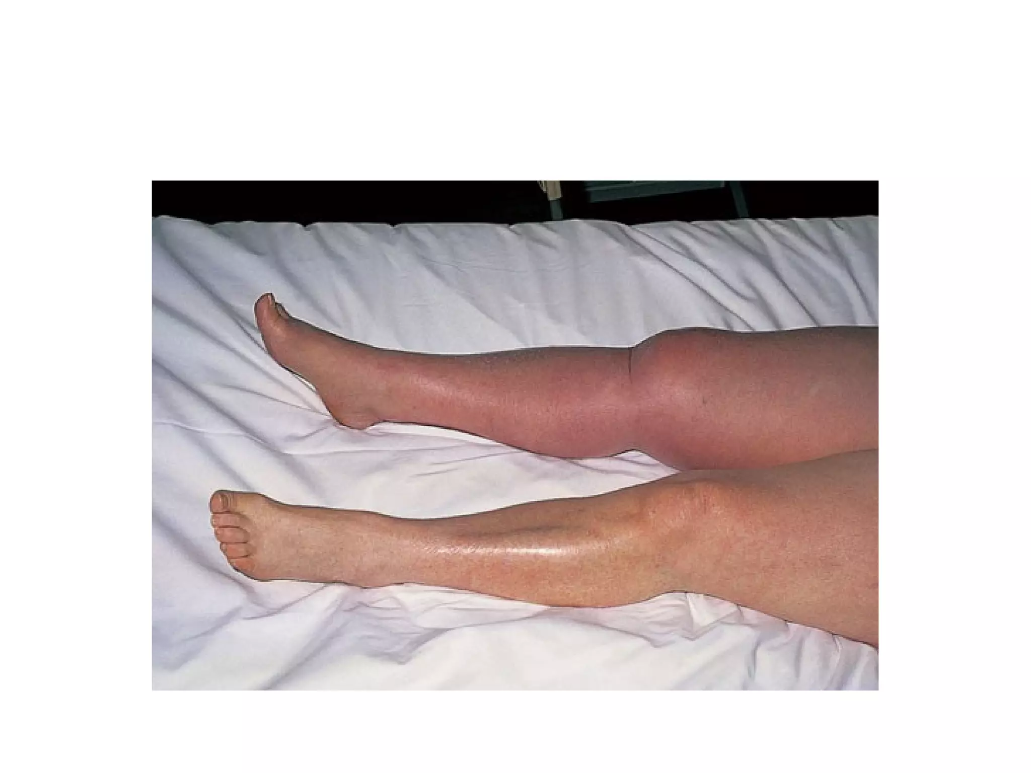 Lymphoedema | PPT