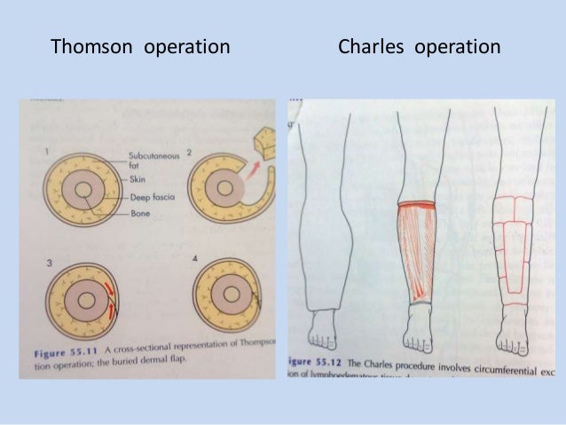 Lymphoedema - Clinical features and Management