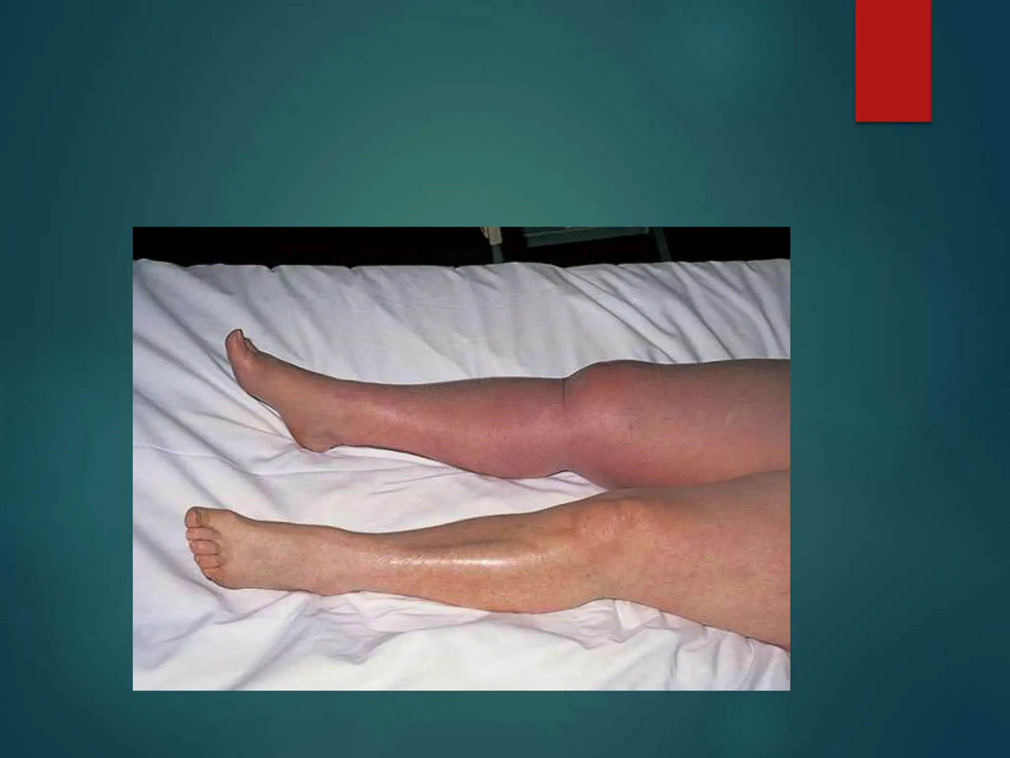 lymphoedema basics and management plan .ppt