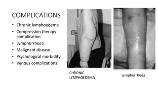 Lymphoedema - Physiotherapy Management | PPTX