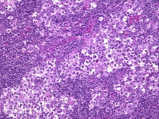 Lymphoid neoplasm | PPT