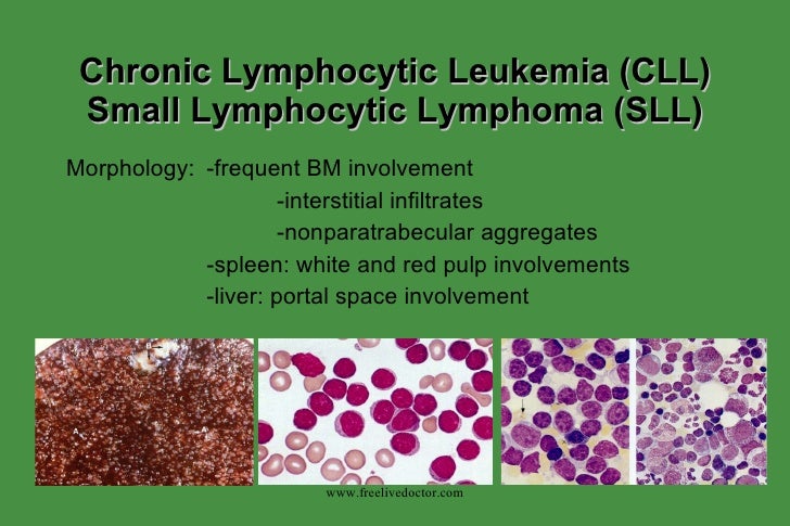 Lymphoma