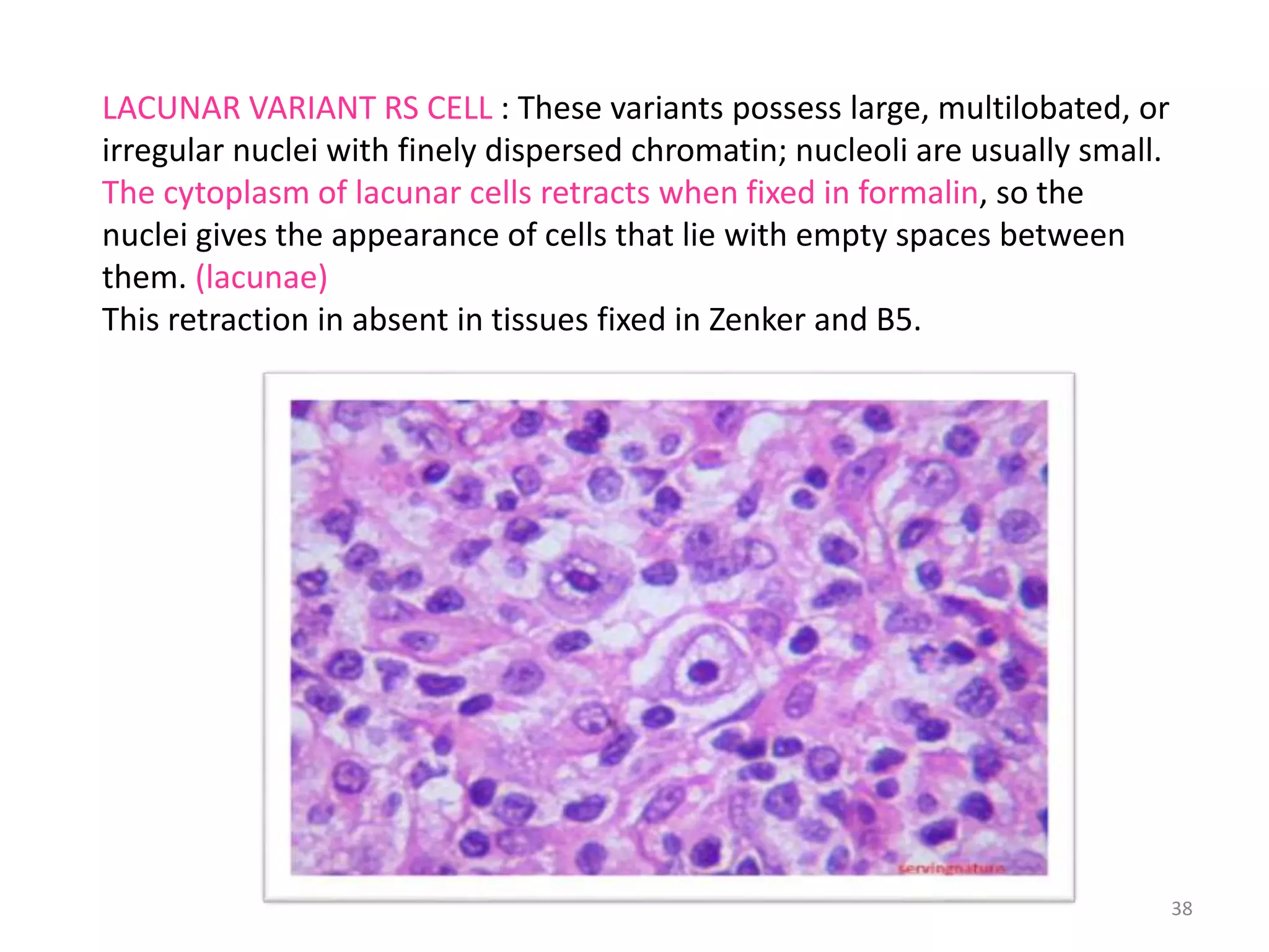 Hodgkin lymphoma | PPTX