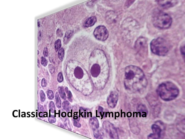 Hodgkins Lymphoma Histology Slide Human