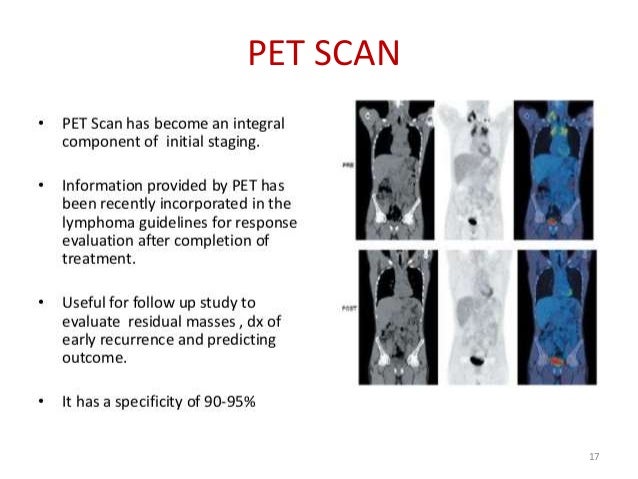Pet Scan Images Of Lymphoma