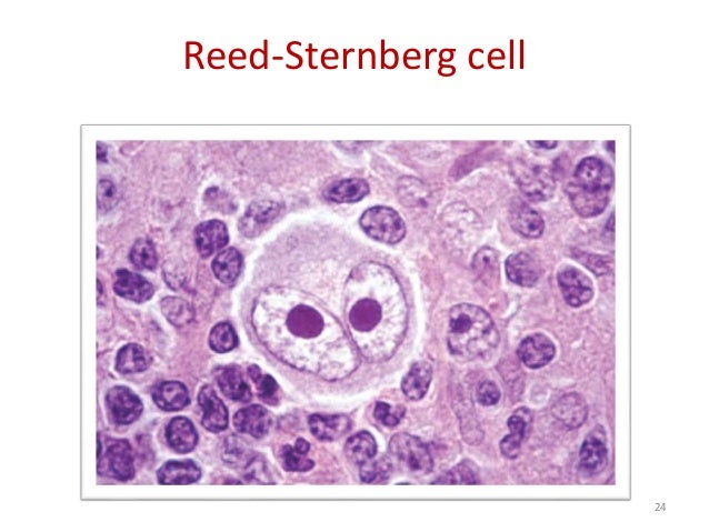 Reed Sternberg Cells