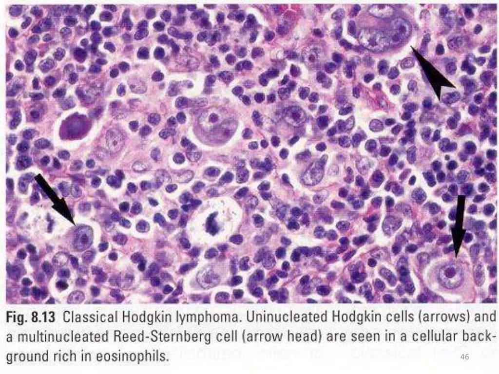 Hodgkin lymphoma