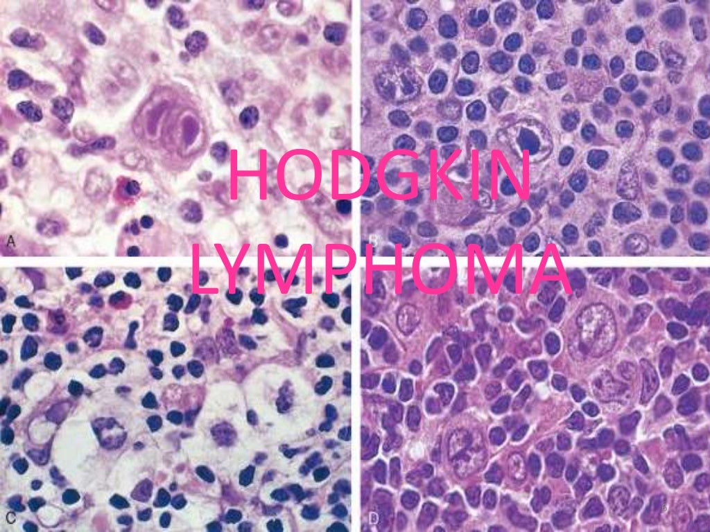 Hodgkin lymphoma