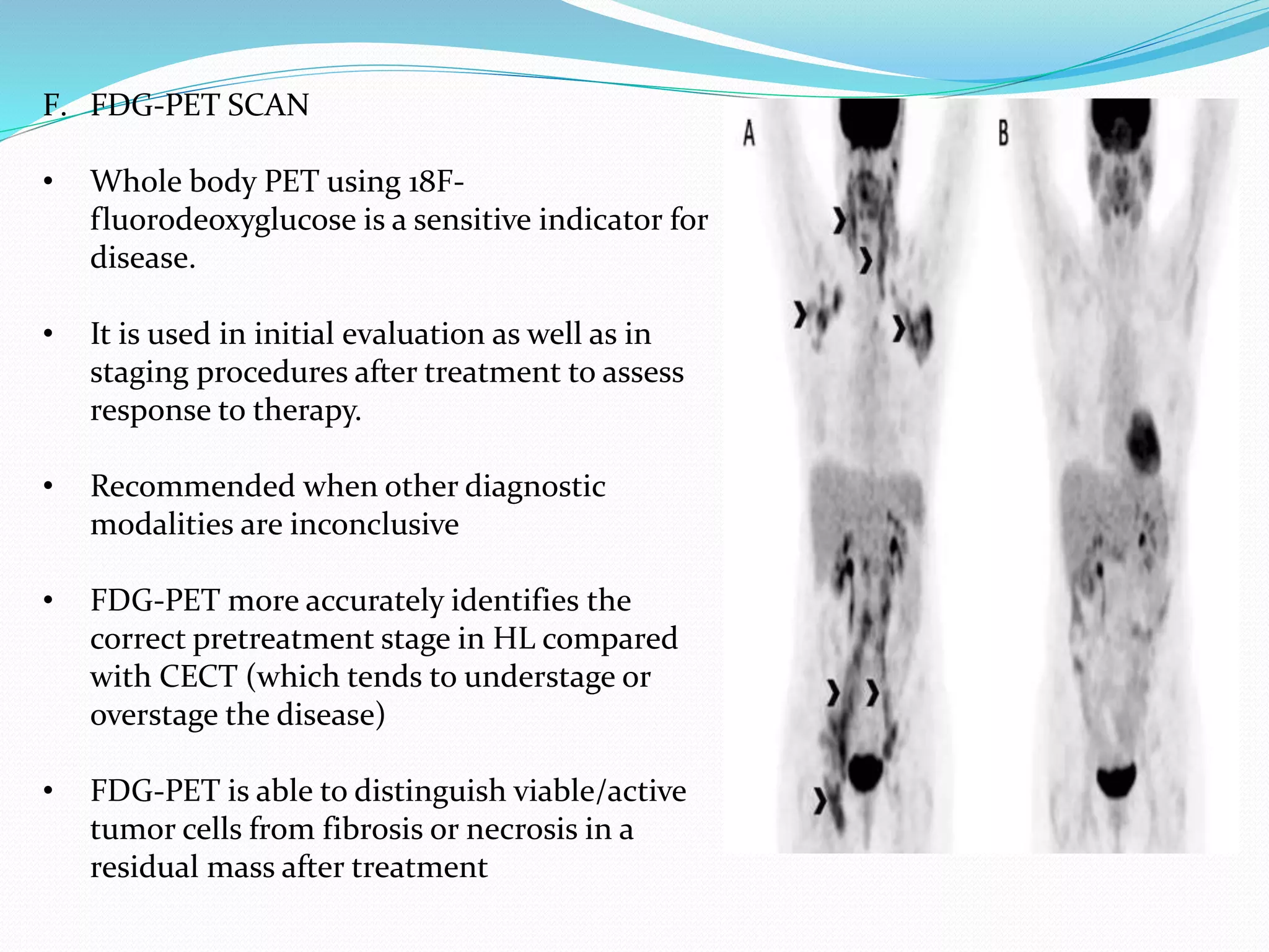 Lymphoma | PPTX