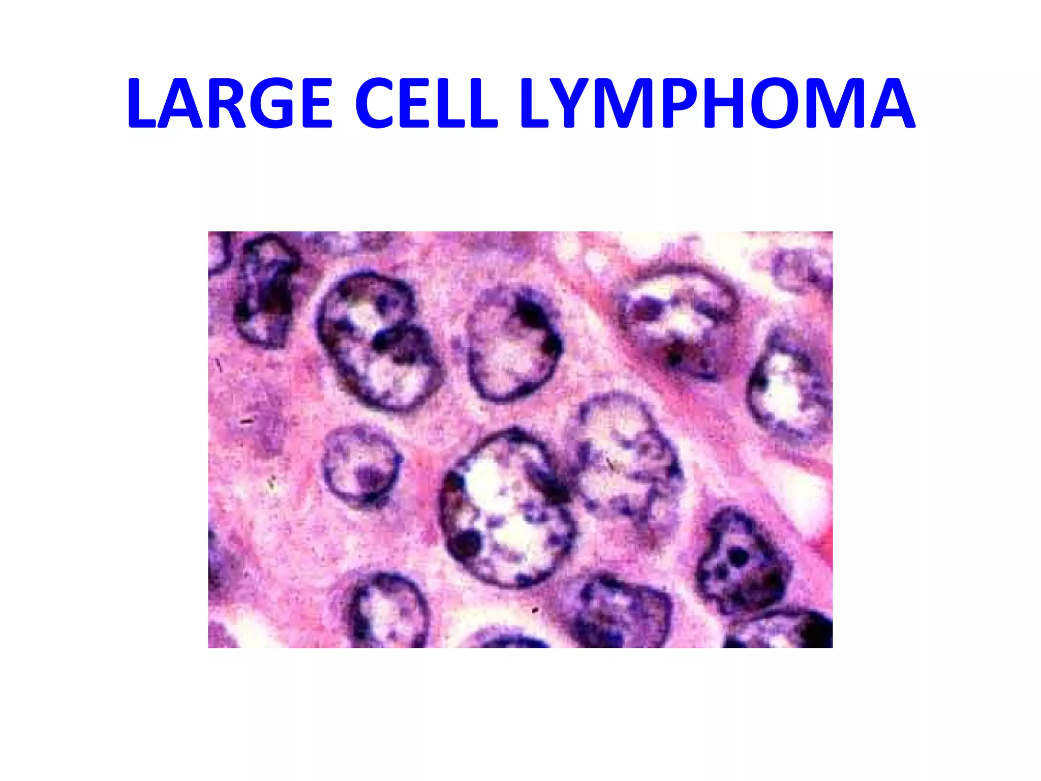 Lymphoma | PPT